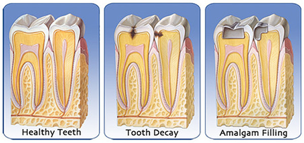 Brentwood Village Dental Clinic | Dental Fillings